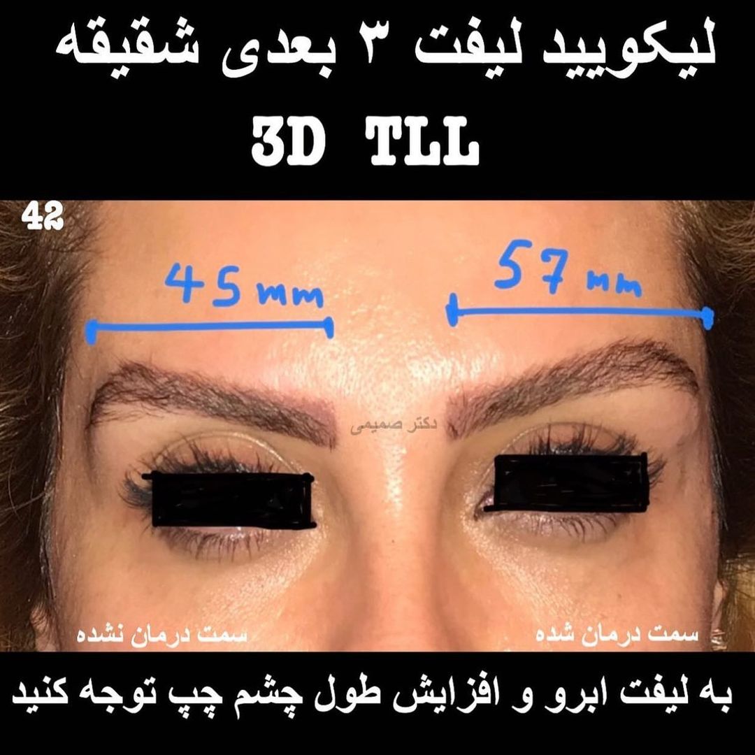 dr.rambod.samimi@instagram on Pinno: این هم مورد دیگری از روش خاص من در ...